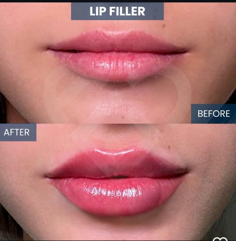 Best Lip Fillers Treatment in Mumbai, dadar – Sskin Savvy